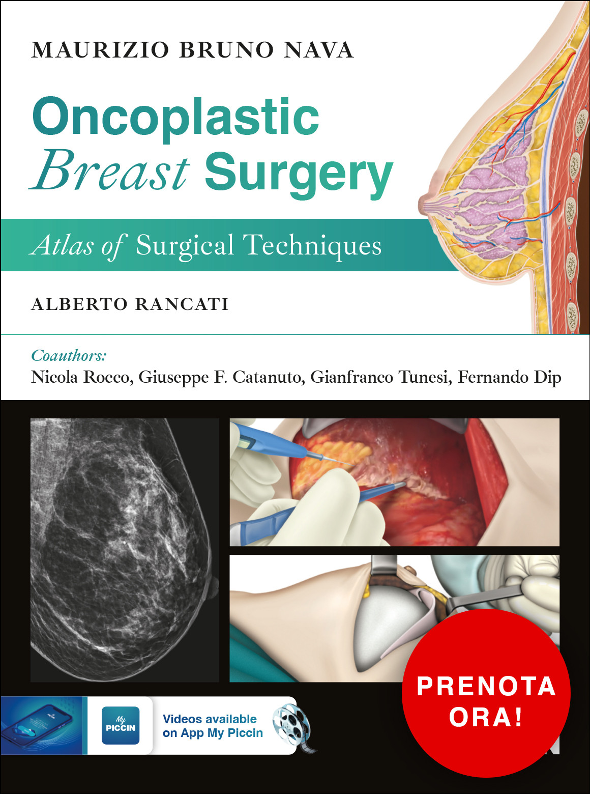 Oncoplastic Breast Surgery. Atlas of Surgical Techniques - PICCIN Nuova Libraria S.P.A.
